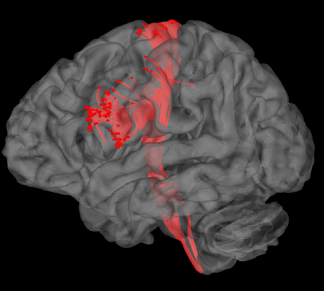 MR Tractography | Elmaci Neuro