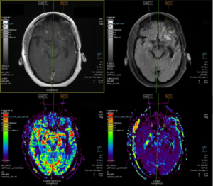 Perfusion MRI | Elmaci Neuro